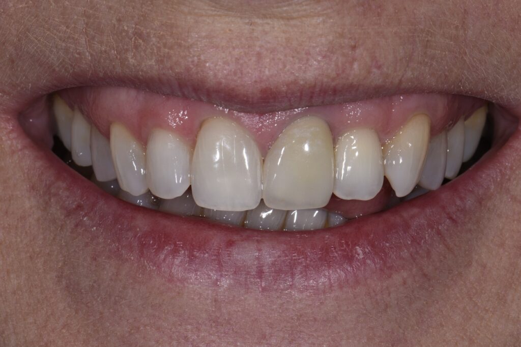 Replacing a single anterior crown to blend