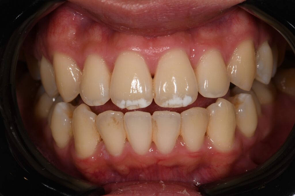 DMG Icon Resin Infiltration | White Spot Treatment