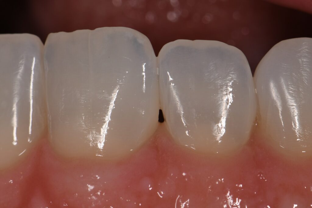 Black Triangle Closure | Gum Loss Black Triangle Closure | Gum Loss