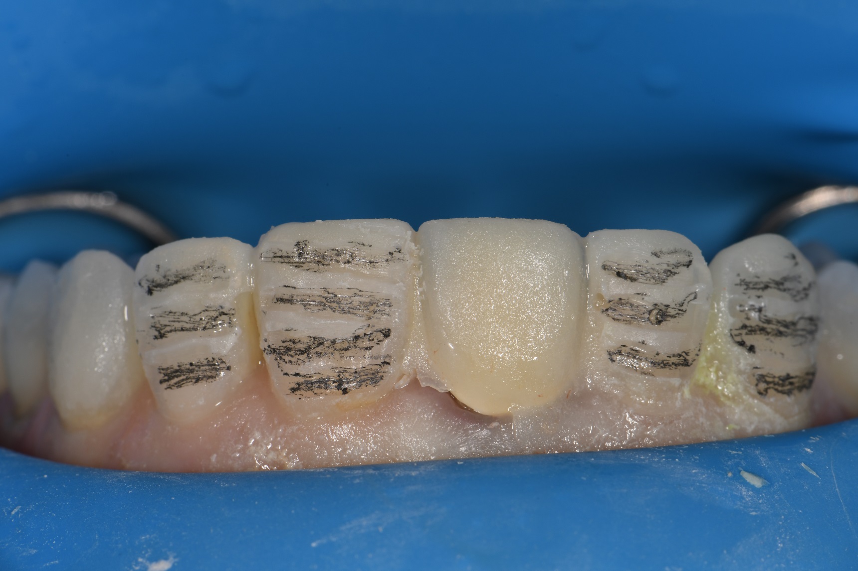 Smile Design using Porcelain Veneers and Crown
