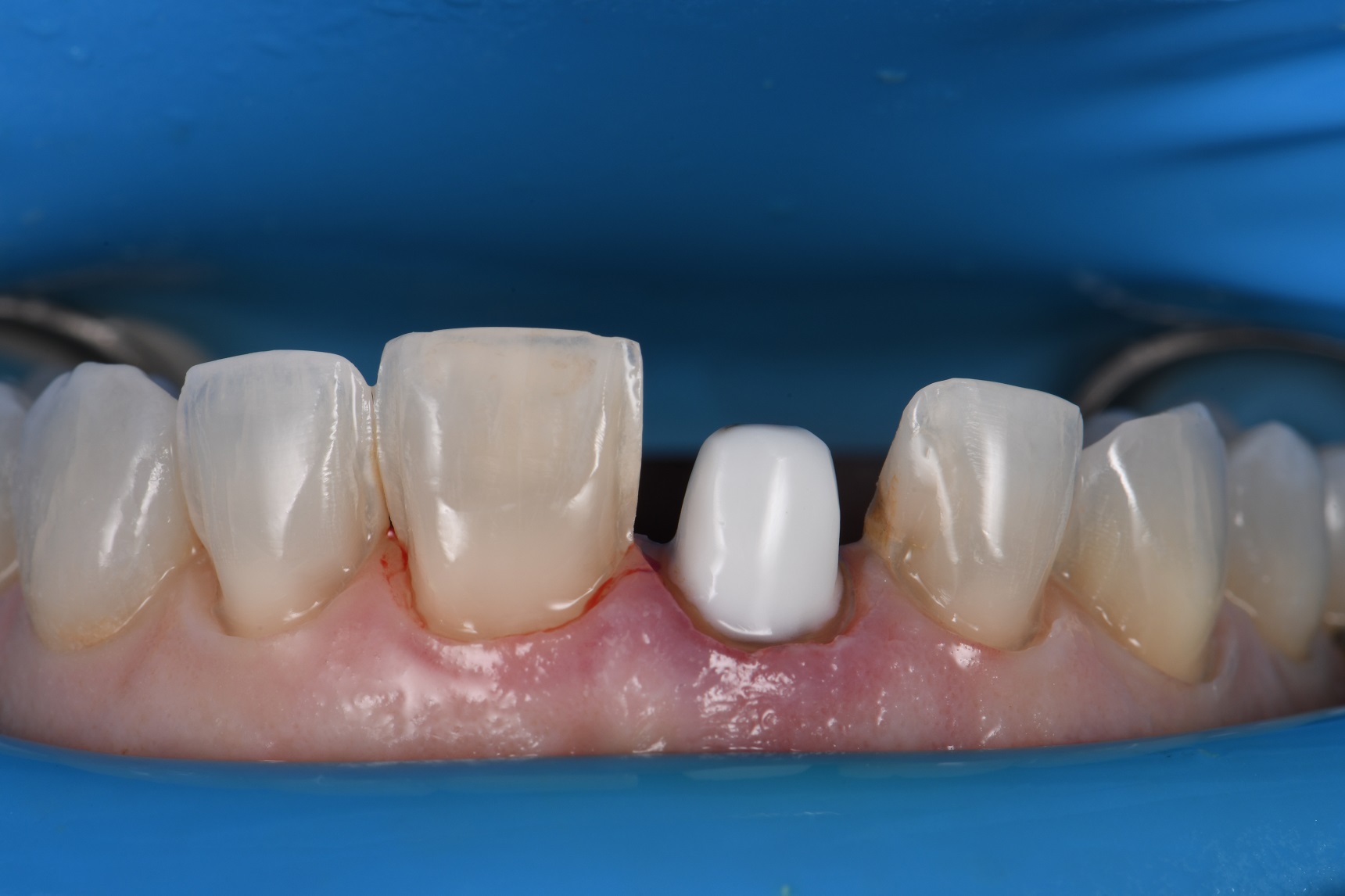 Smile Design using Porcelain Veneers and Crown