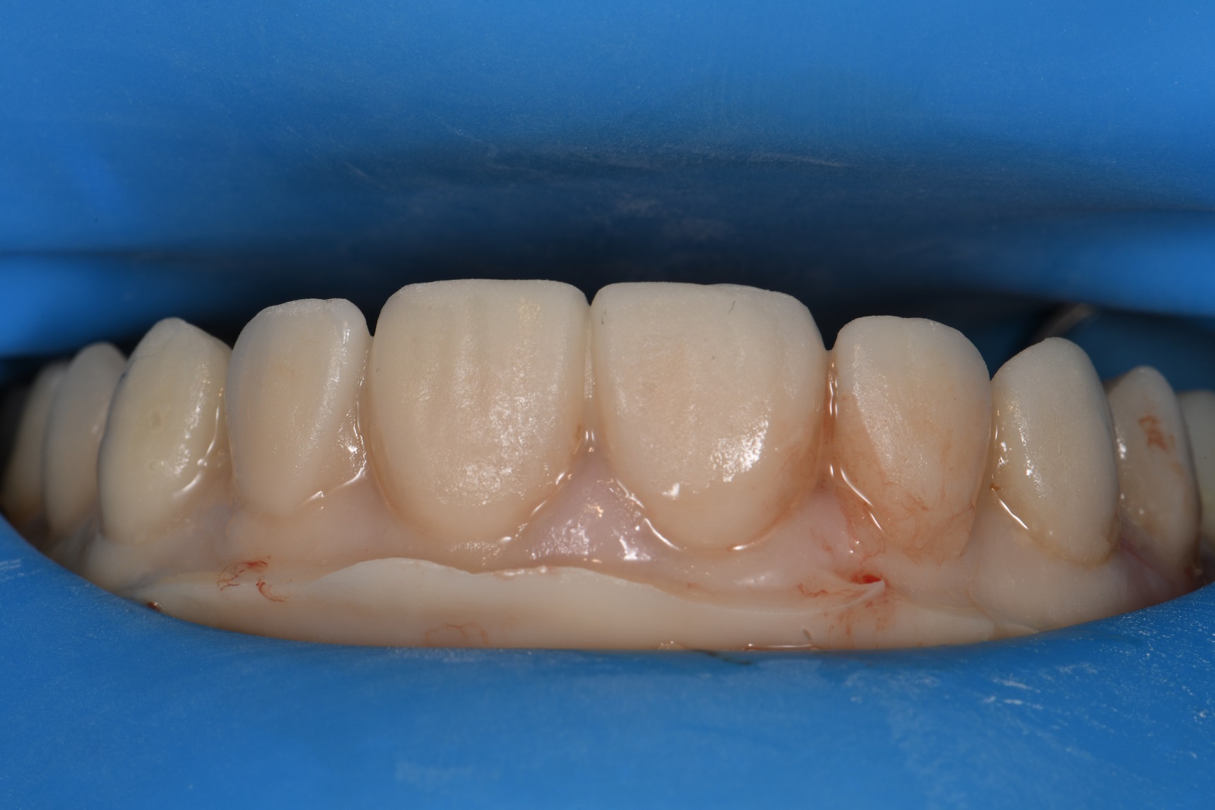 Kerr Optiview | Indirect Re-preparations