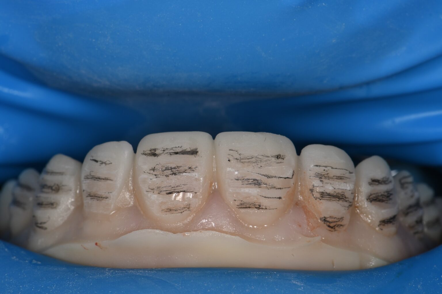 Kerr Optiview | Indirect Re-preparations