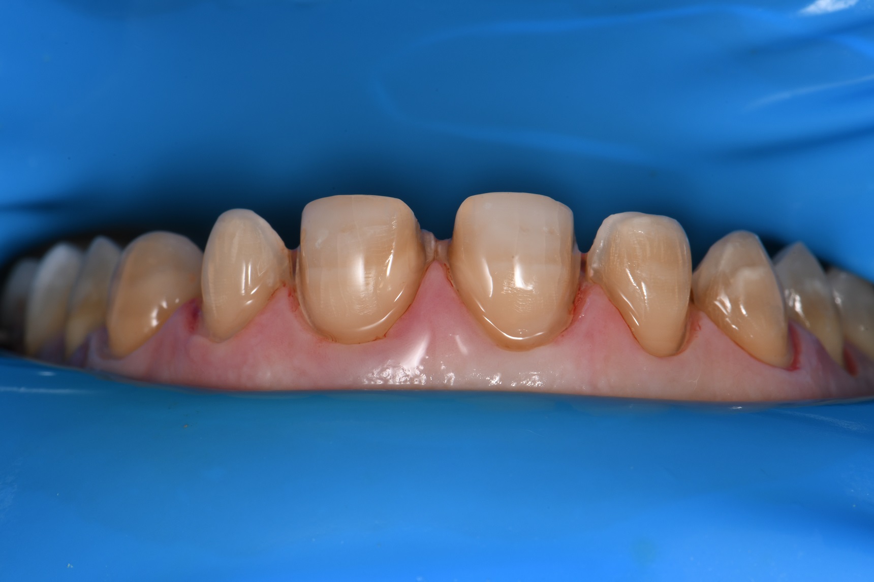 Immediate Post operative Result | Veneers Auckland