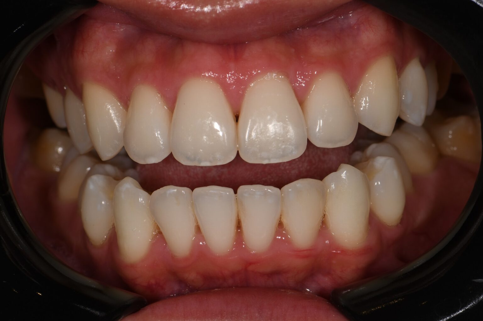 DMG Icon Resin Infiltration | White Spot Treatment