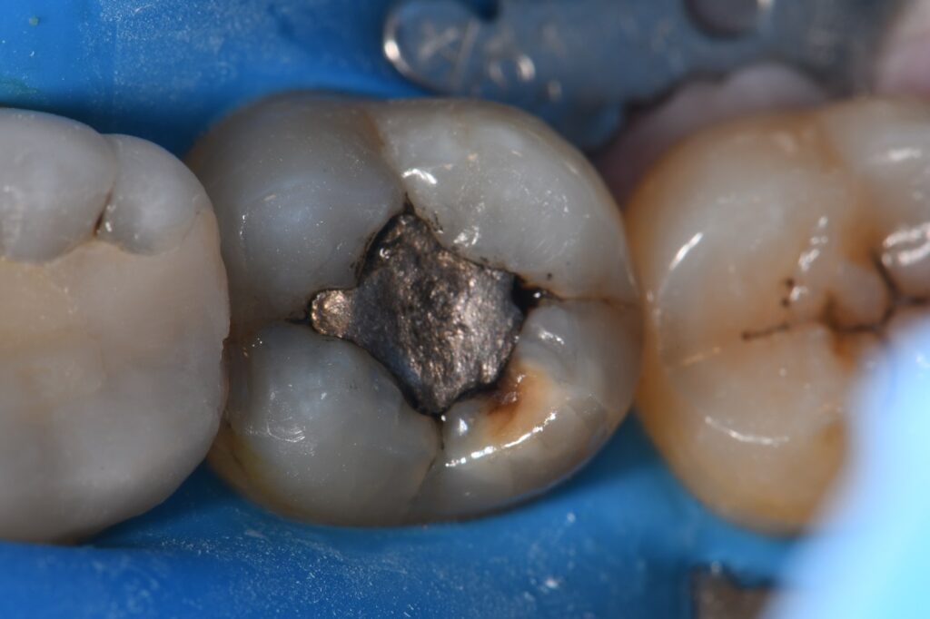 Whitening Grey Teeth with Composite Whitening Grey Teeth with Composite