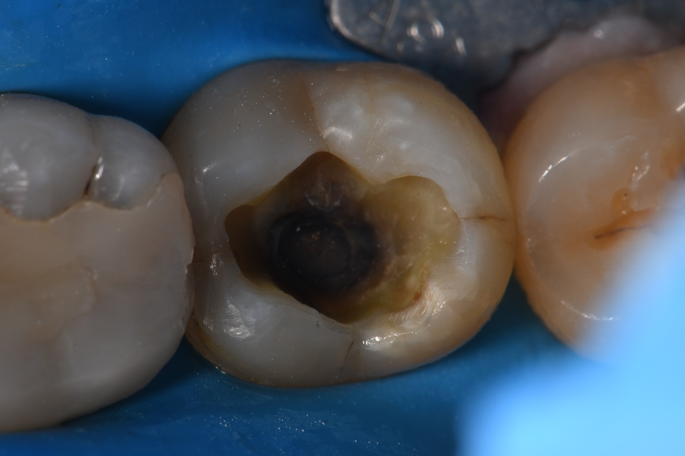 Whitening Grey Teeth with Composite Whitening Grey Teeth with Composite