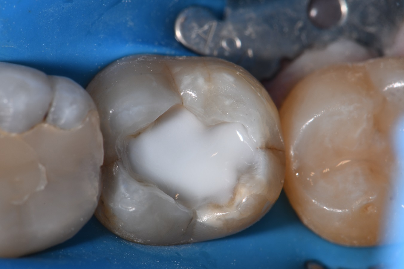Whitening Grey Teeth with Composite Whitening Grey Teeth with Composite