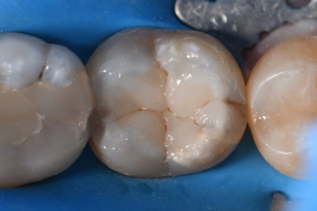 Whitening Grey Teeth with Composite Whitening Grey Teeth with Composite