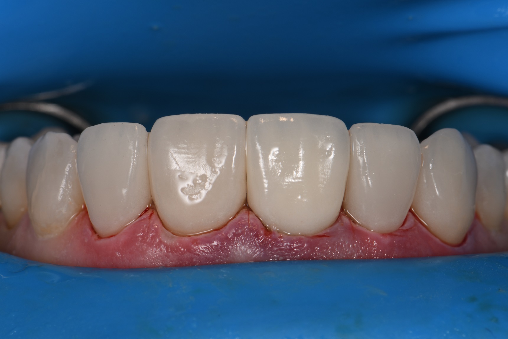 Smile Design using Porcelain Veneers and Crown