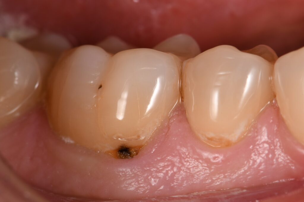 Cervical carious lesions