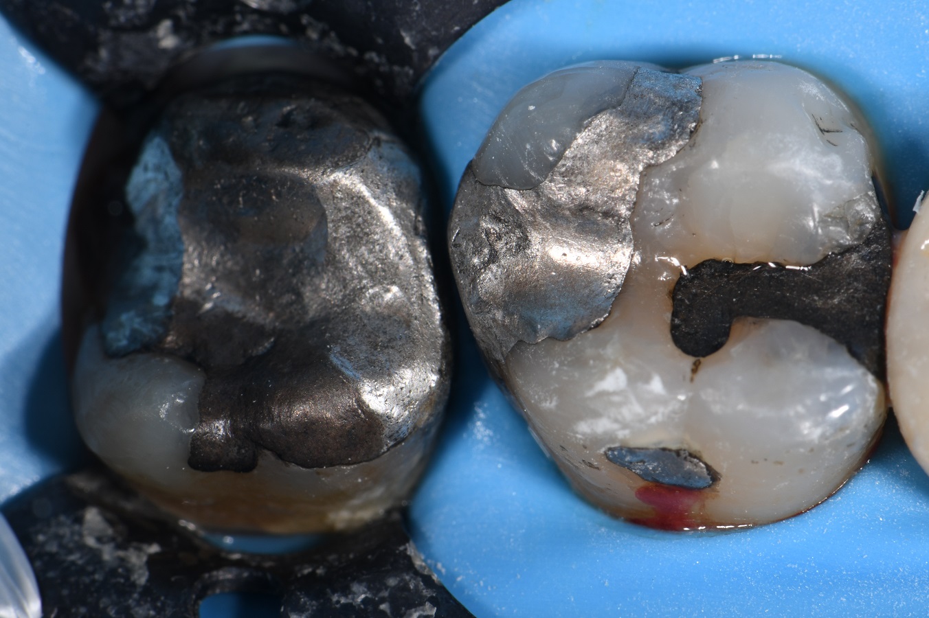 Saving Near Unrestorable Teeth