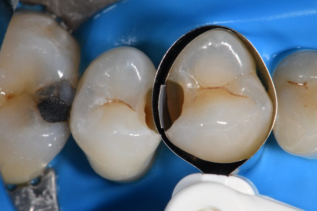 The luxury composite resin material