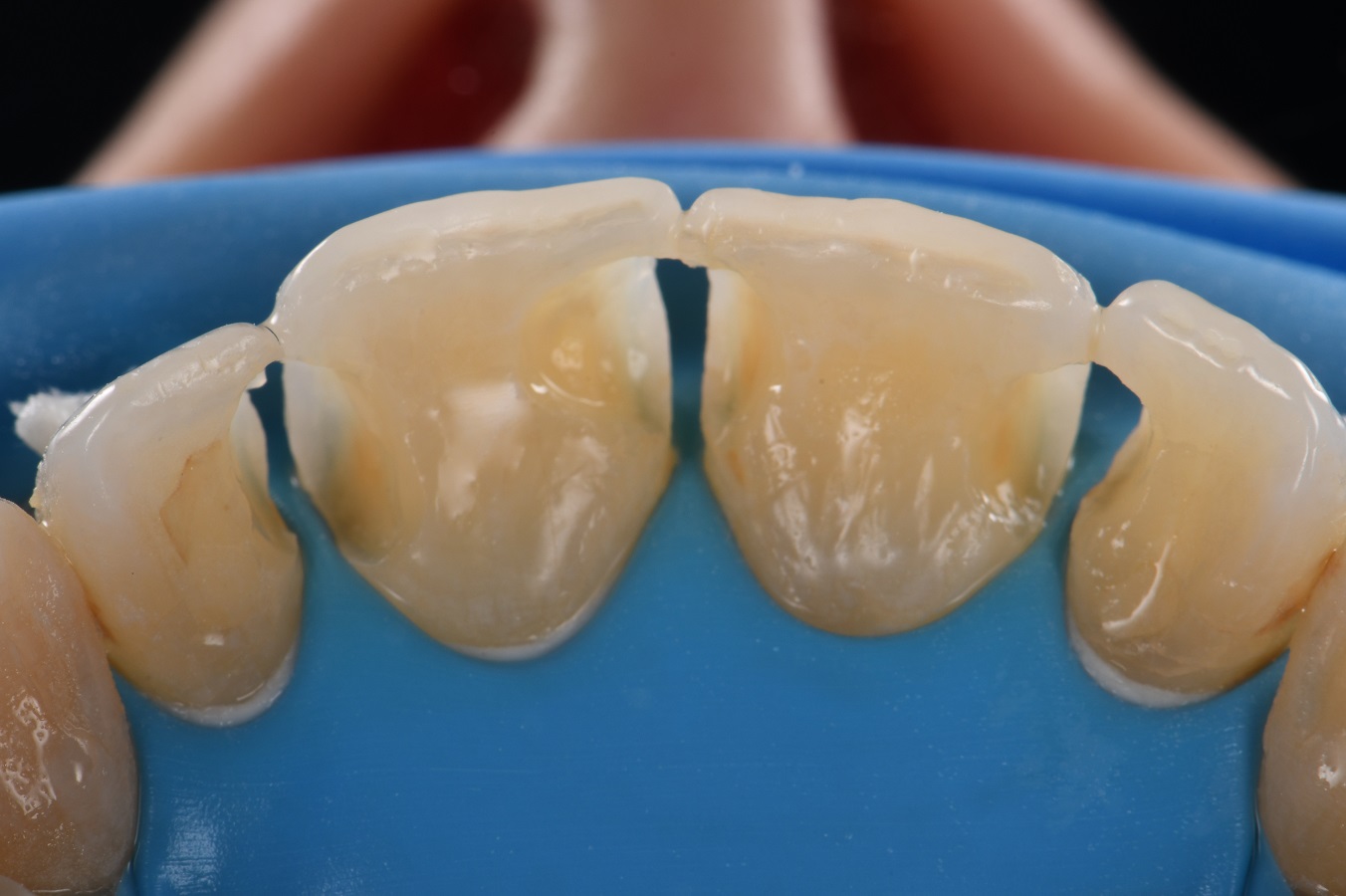 Class III resin esthetic integration