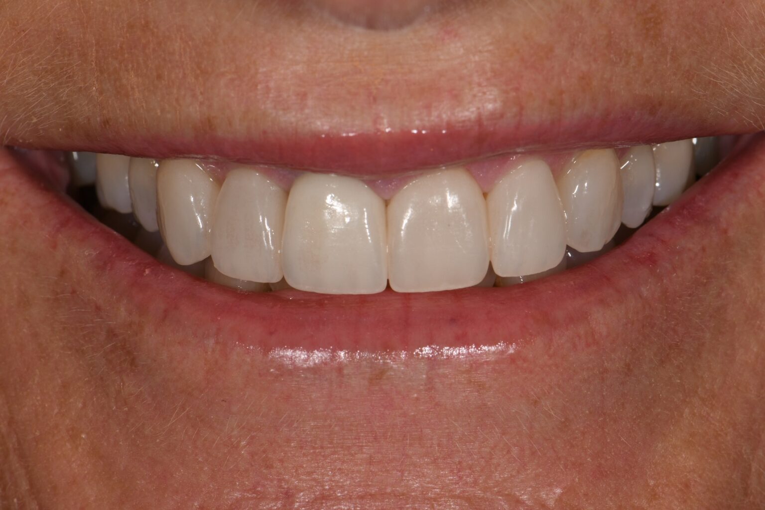 Smile Design with 5 porcelain veneers Smile Design with 5 porcelain veneers