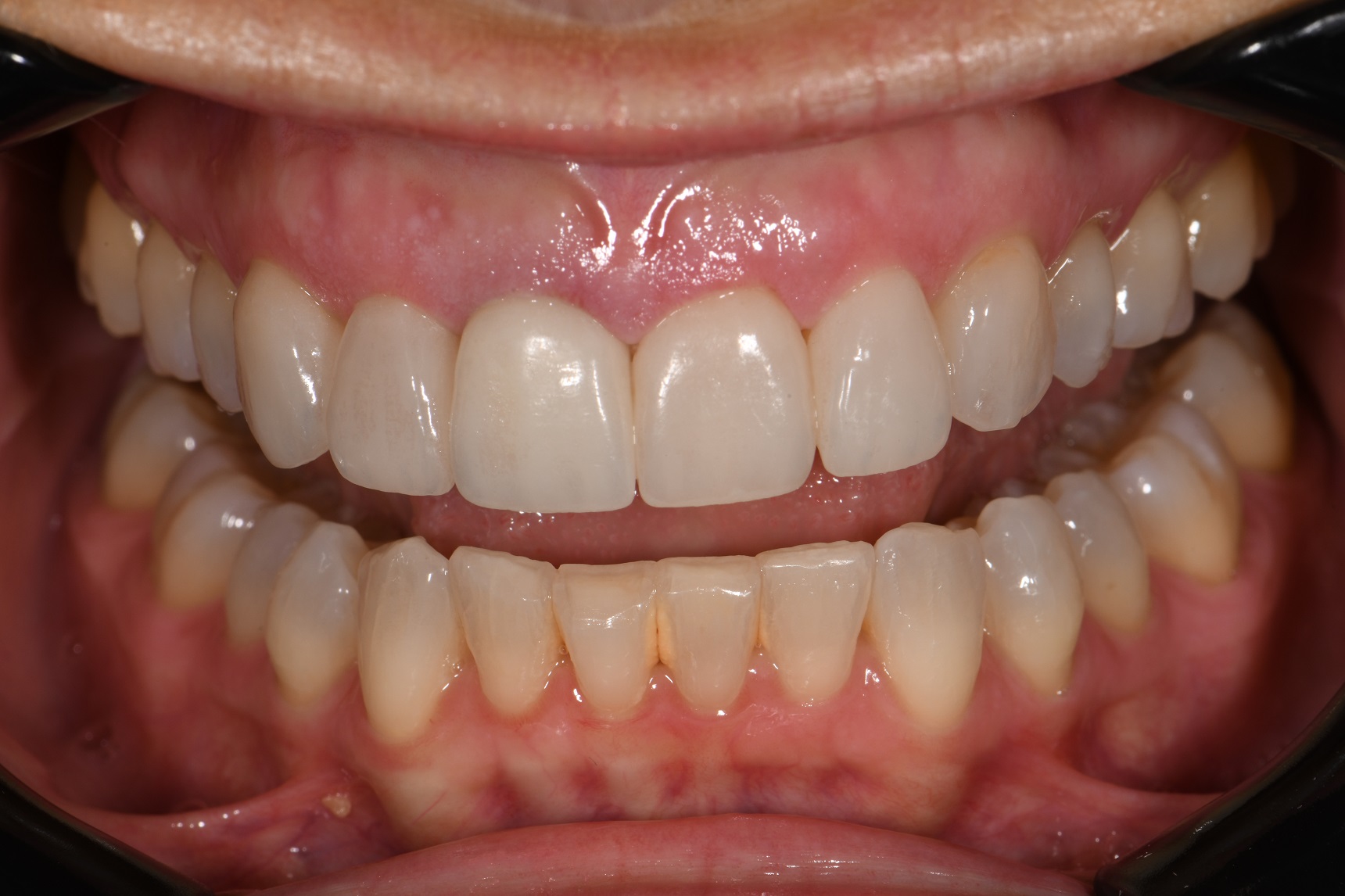 Smile Design with 5 porcelain veneers Smile Design with 5 porcelain veneers