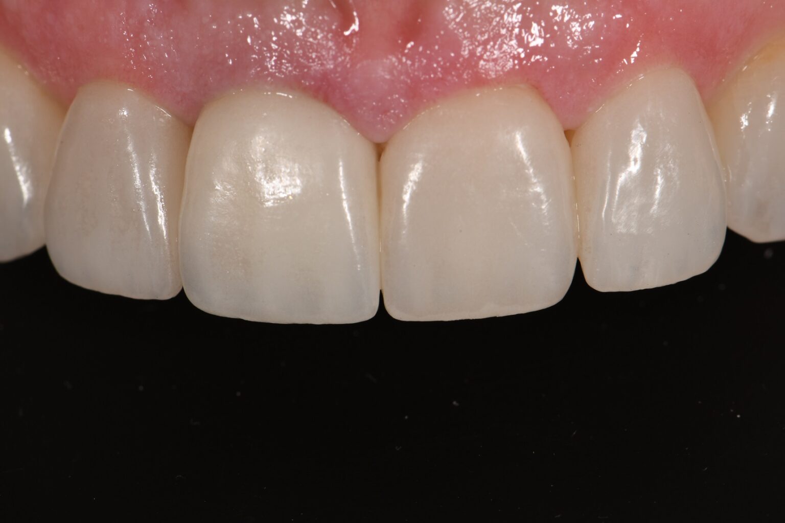 Smile Design with 5 porcelain veneers Smile Design with 5 porcelain veneers