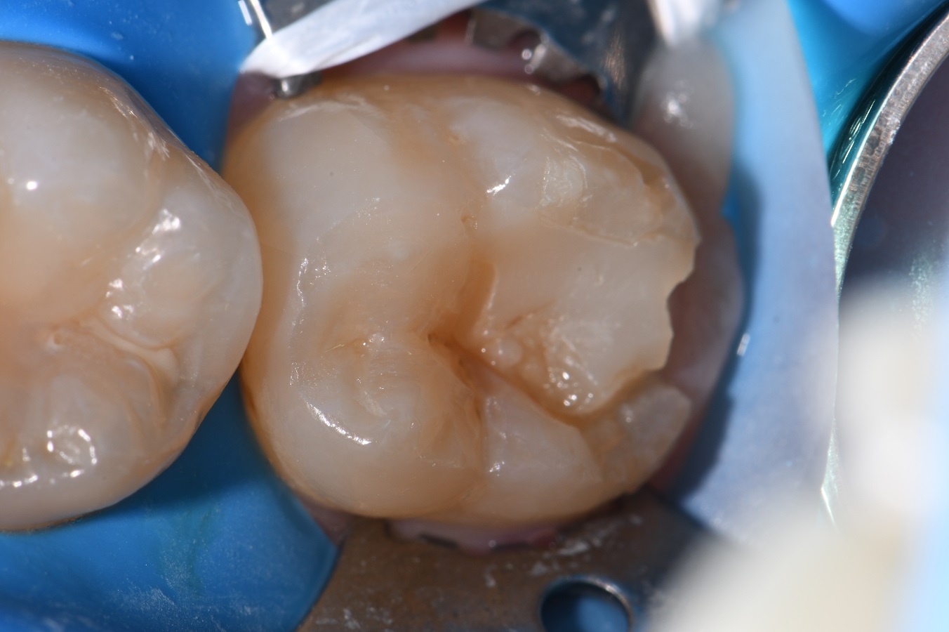 Fractured marginal ridge reconstruction #KerrSimplishade # ...