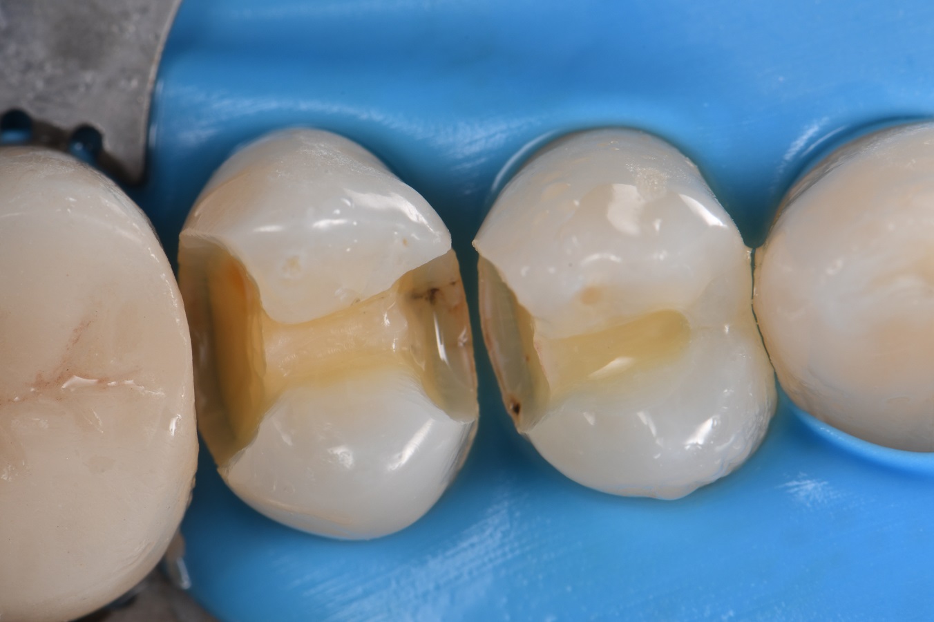 Class II Esthetics Matrix in Matrix Class II Esthetics Matrix in Matrix