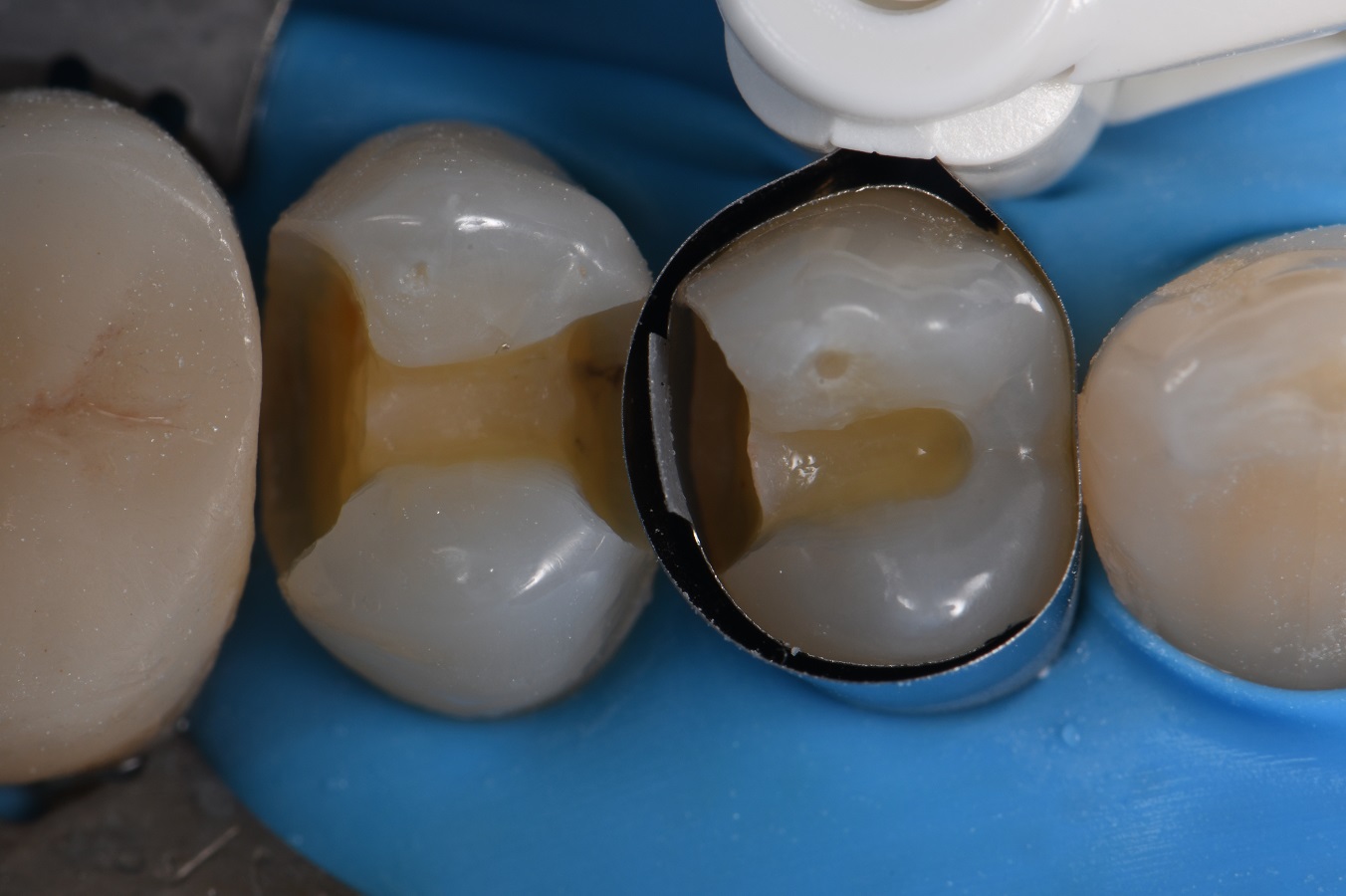 Class II Esthetics Matrix in Matrix Class II Esthetics Matrix in Matrix