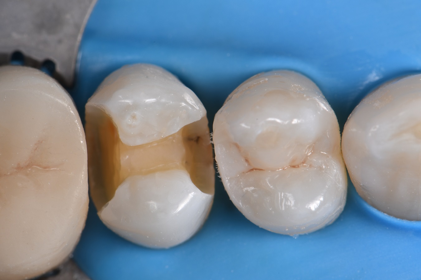 Class II Esthetics Matrix in Matrix Class II Esthetics Matrix in Matrix