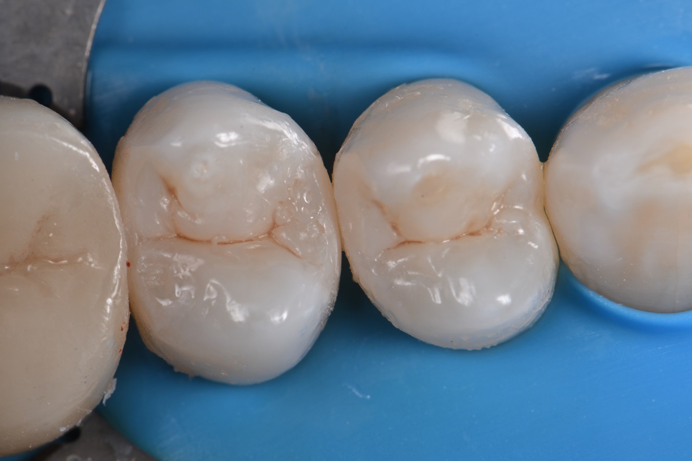 Class II Esthetics Matrix in Matrix Class II Esthetics Matrix in Matrix