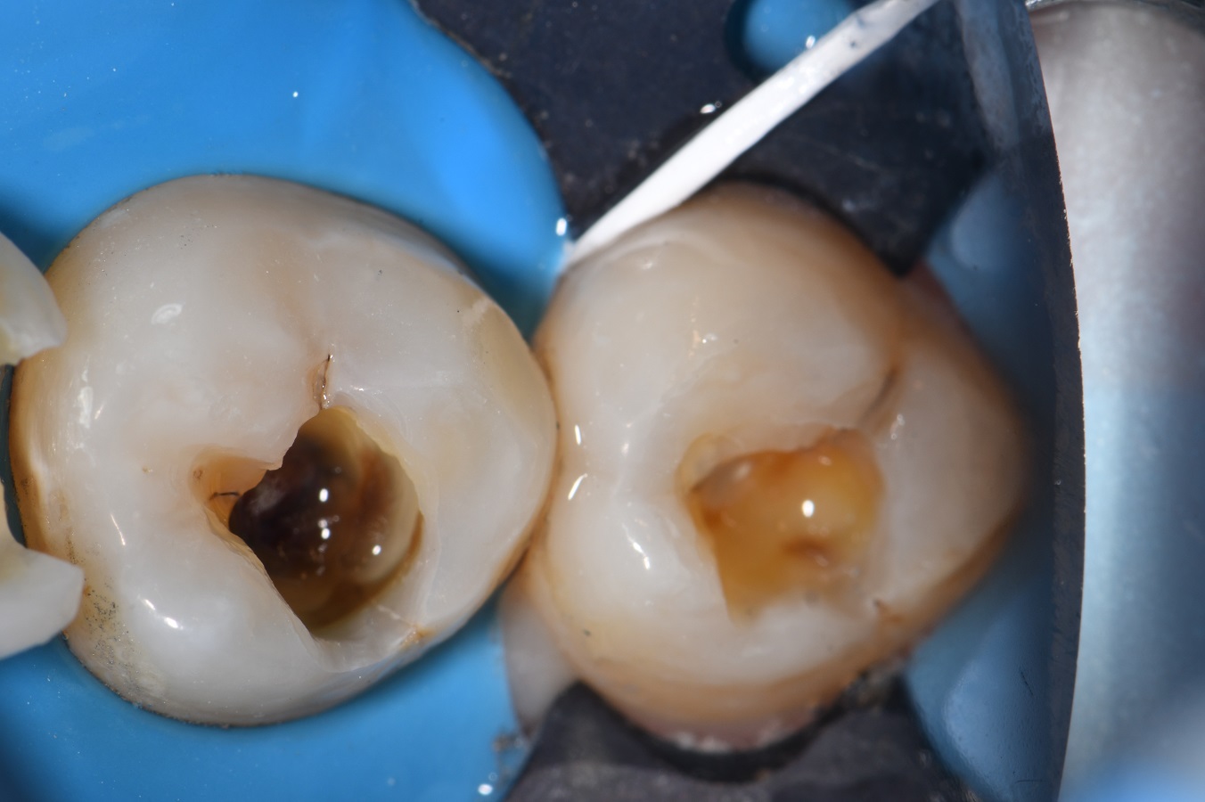 Class I cavities with dark base