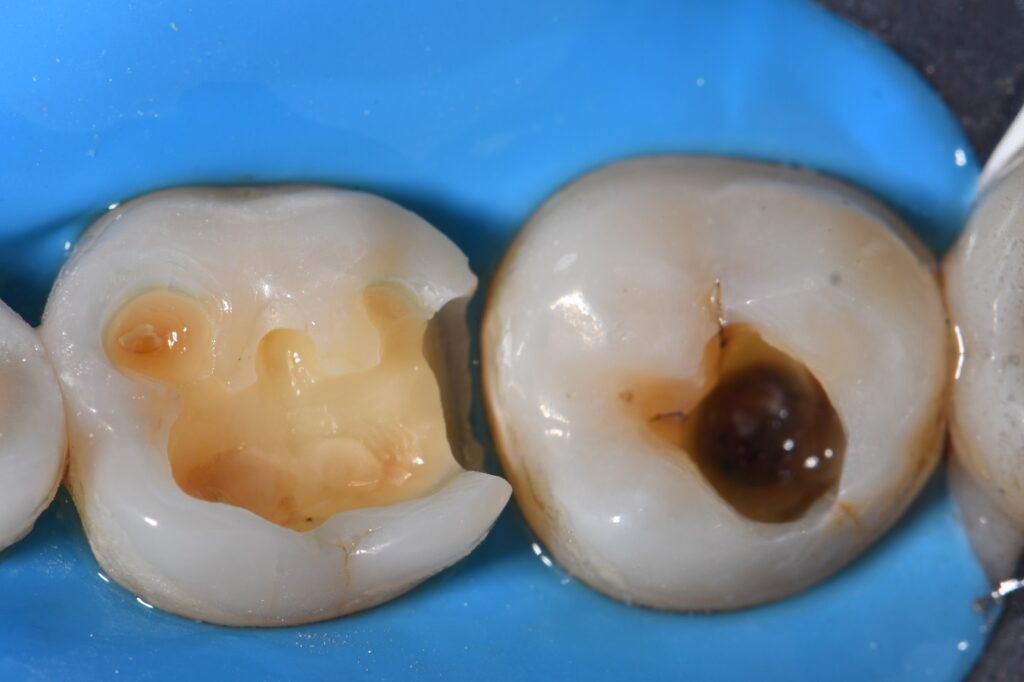 Cavities between the teeth