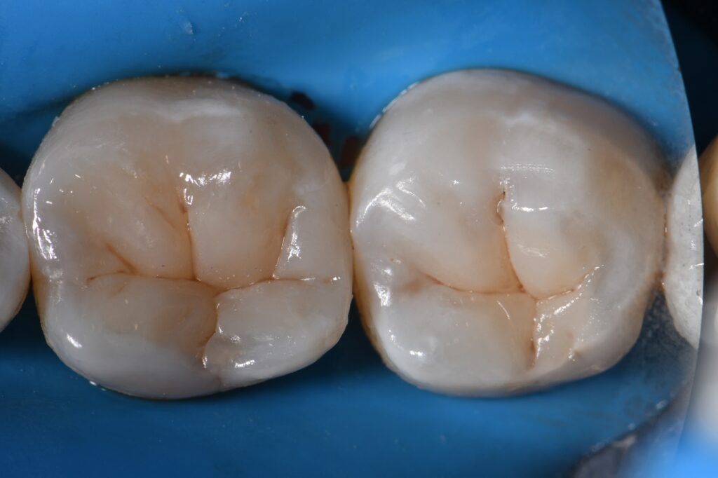 Cavities between the teeth