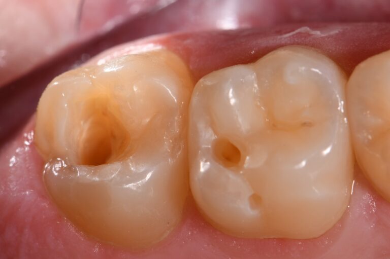 Deep caries in a teenage male