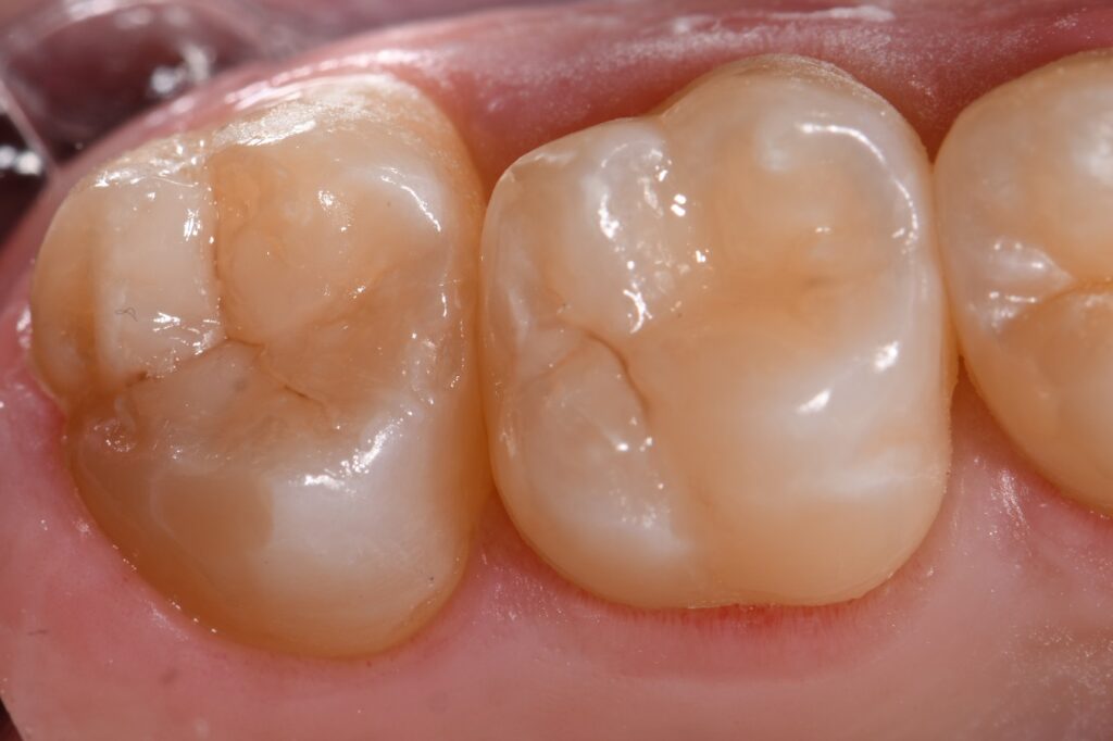 Deep caries in a teenage male