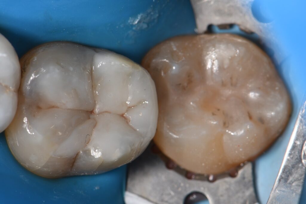 Making Grey Teeth Whiter