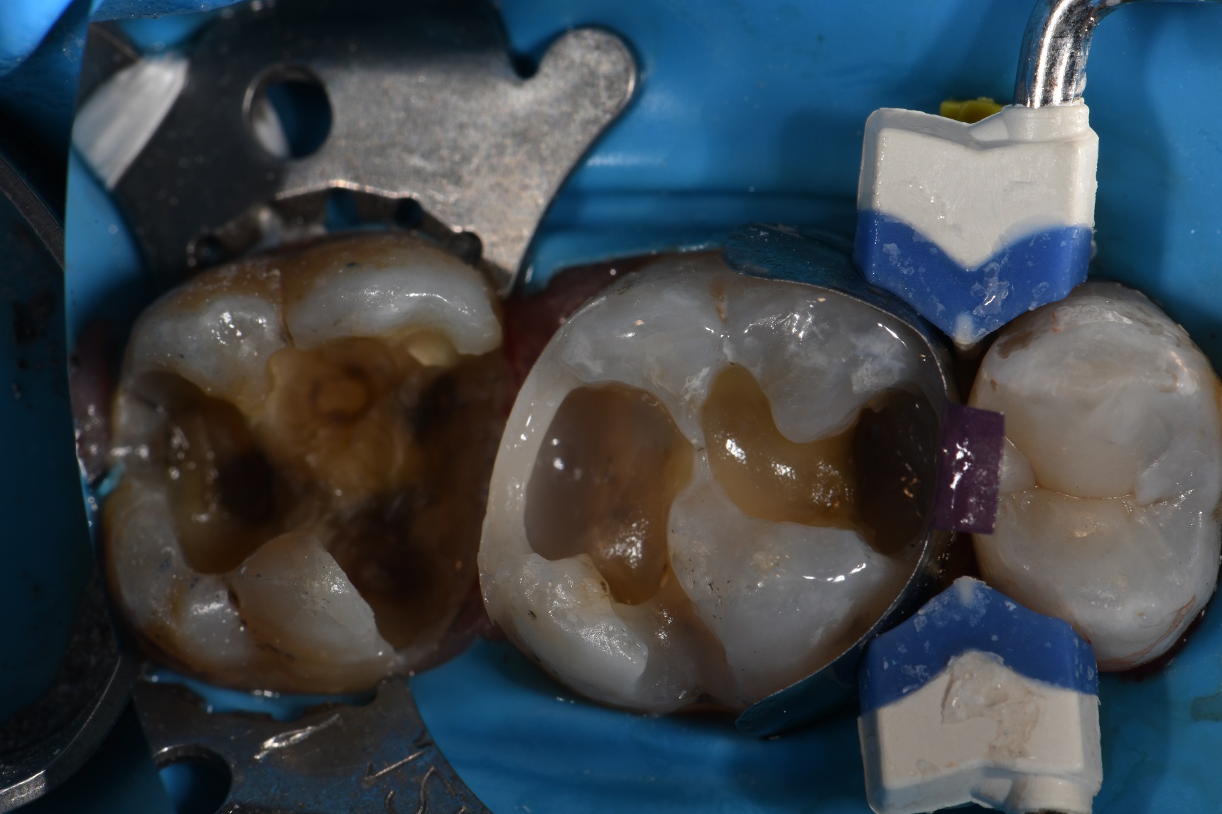 Complex extensive Class II direct restorations Complex extensive Class ...