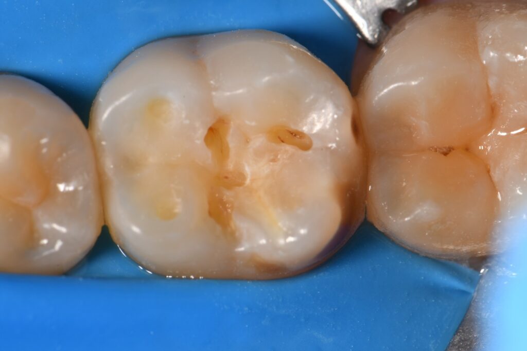 Conservative Composite Restoration