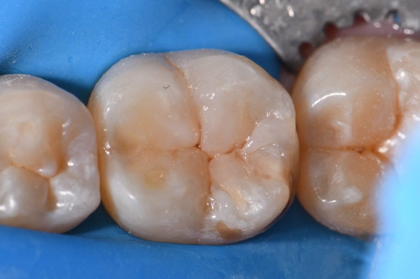 Conservative Composite Restoration