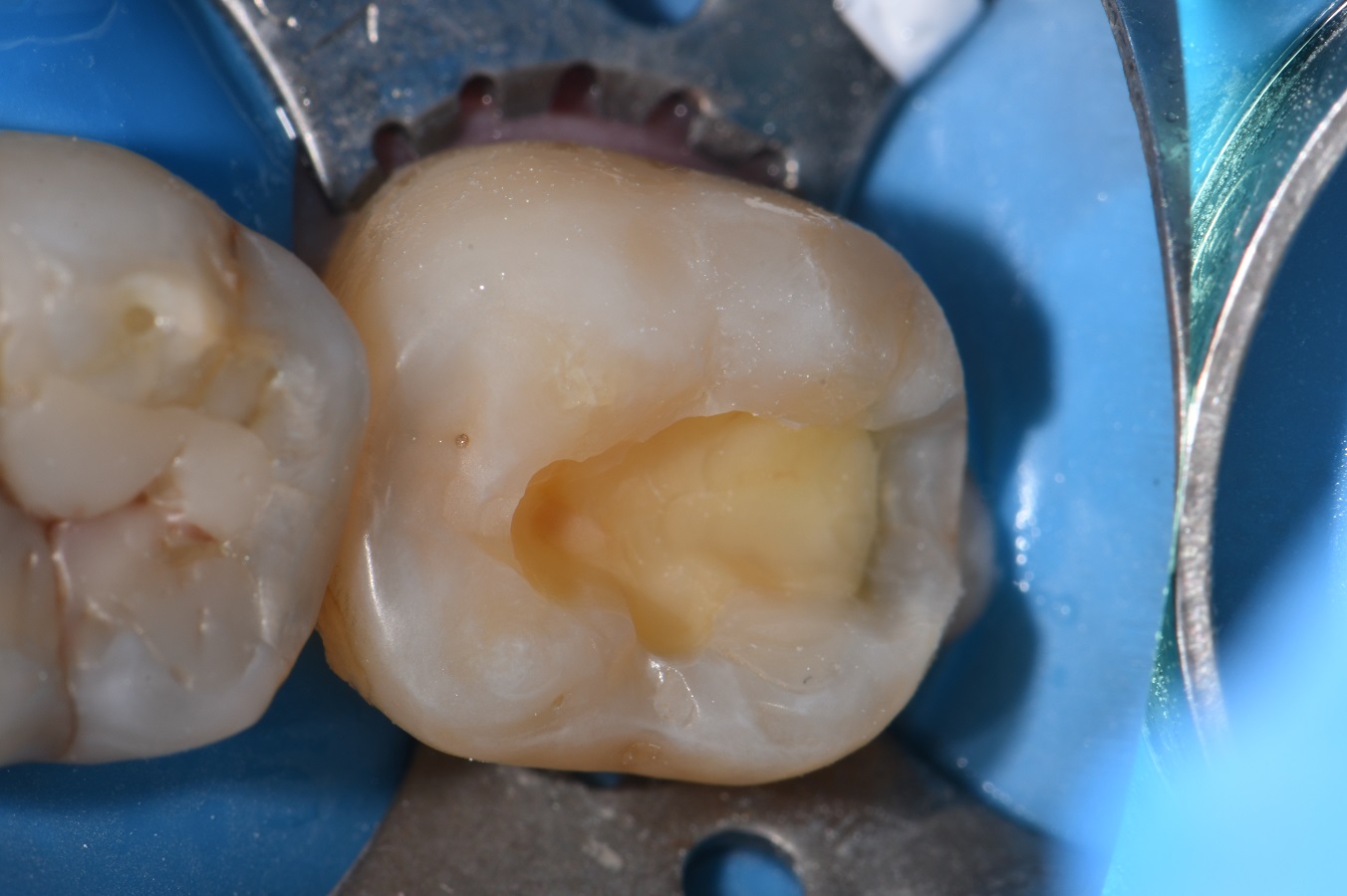 Shallow Class II composite restoration