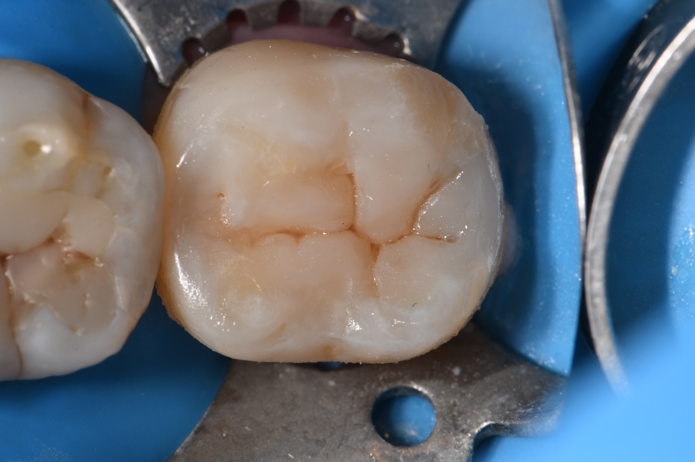 Shallow Class II composite restoration