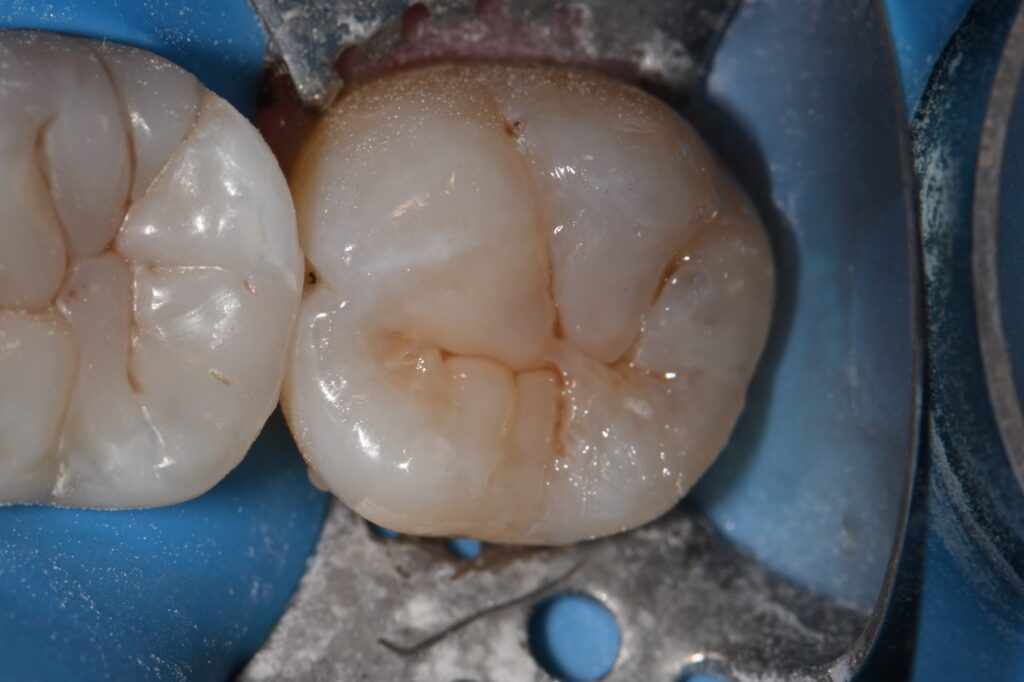 Variant Class I resin anatomy