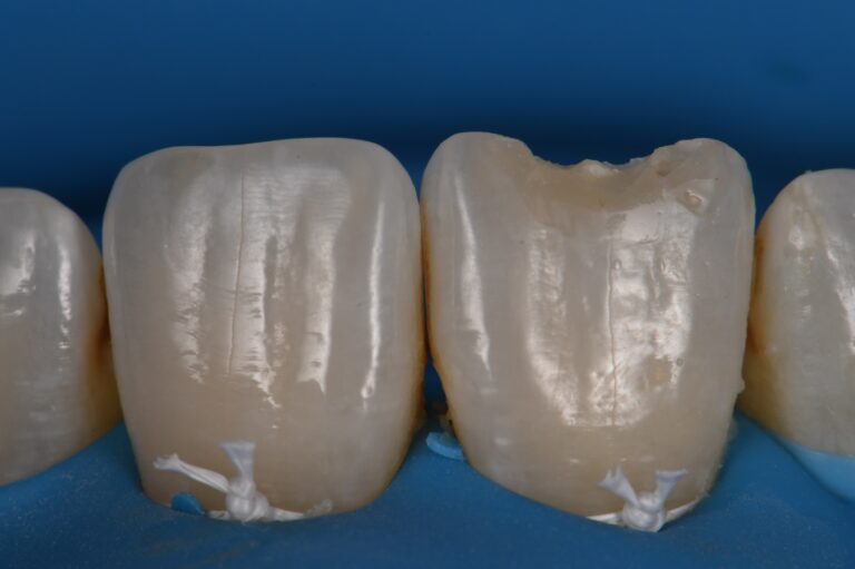 Composite Veneer | Voco Amaris