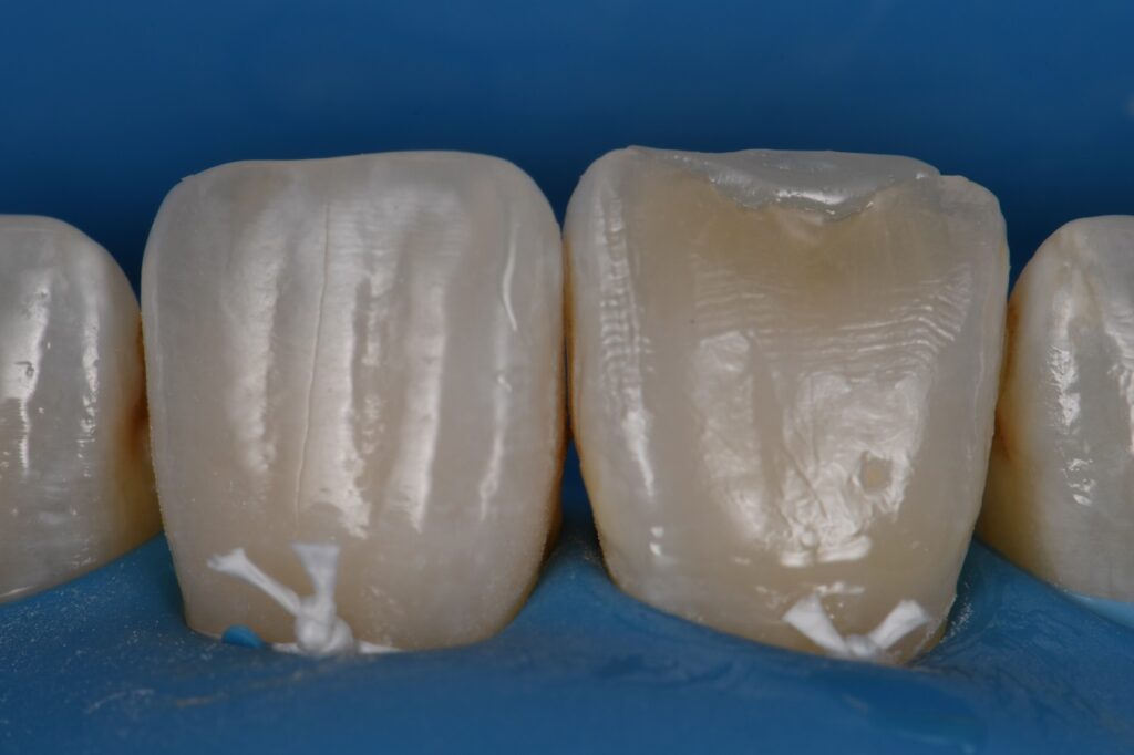 Composite Veneer | Voco Amaris