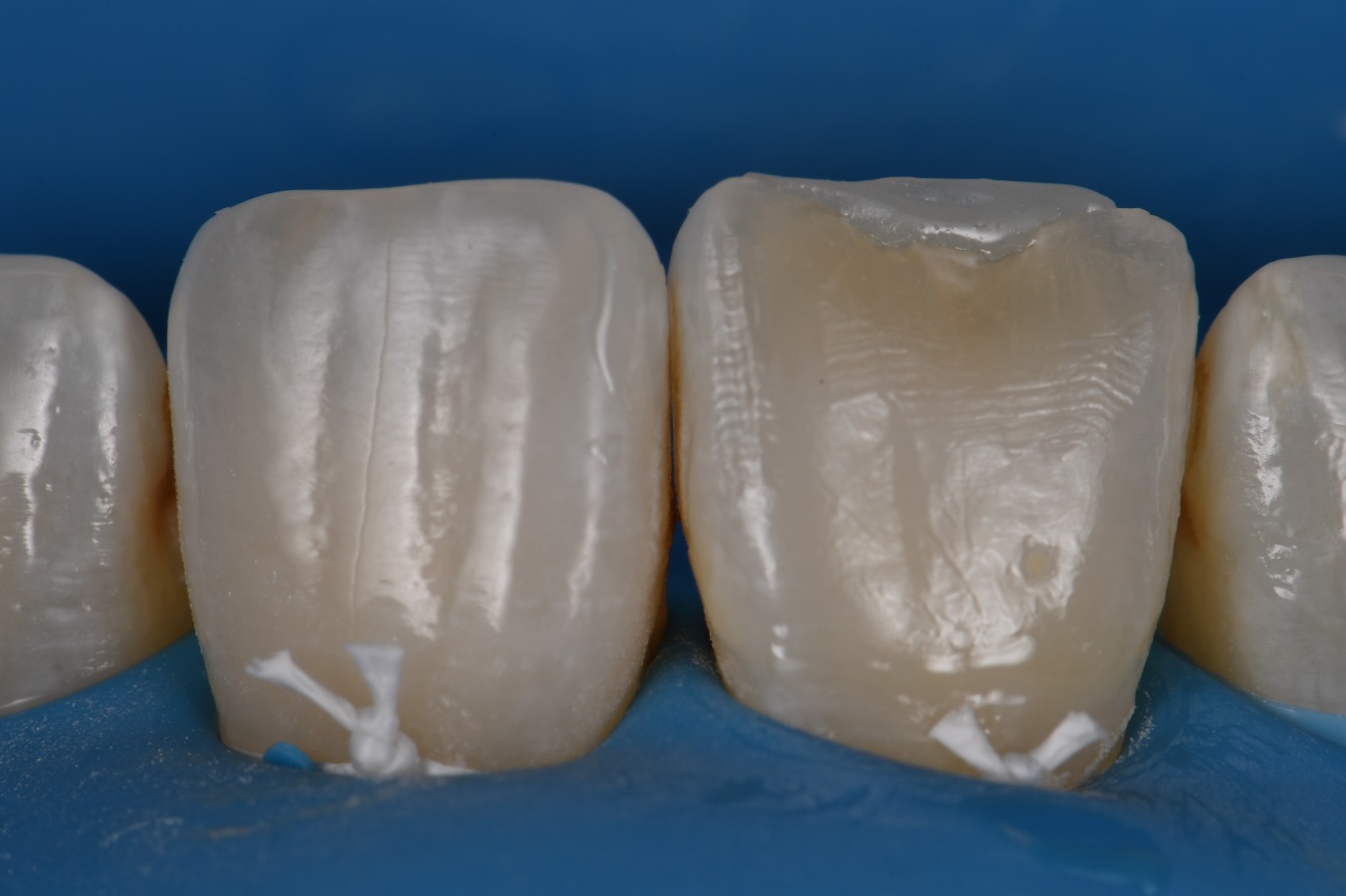 Composite Veneer | Voco Amaris