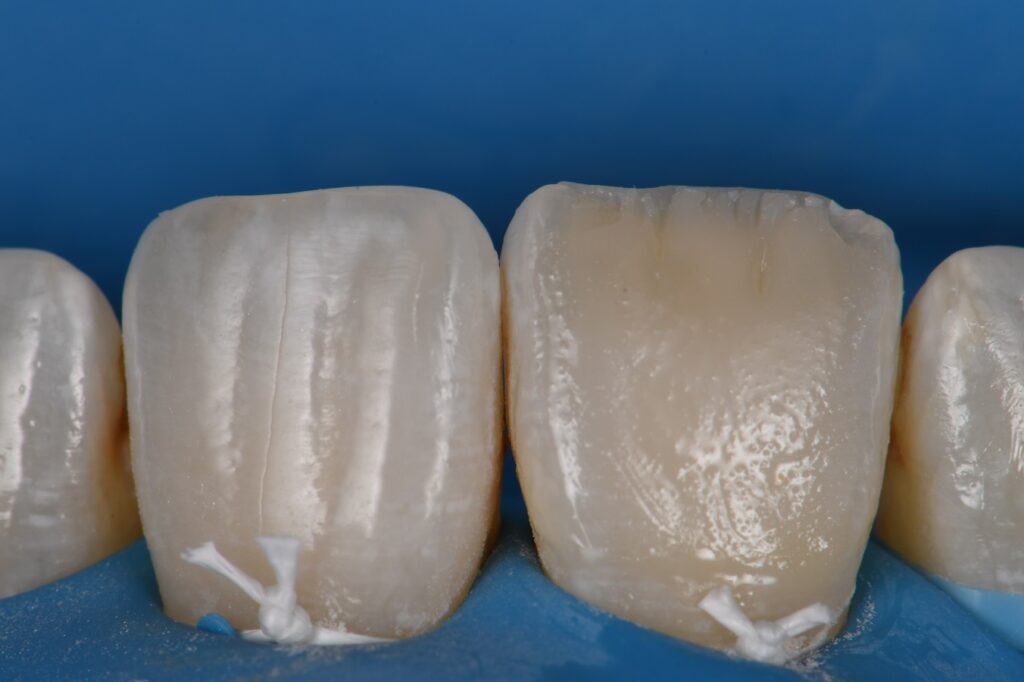 Composite Veneer | Voco Amaris