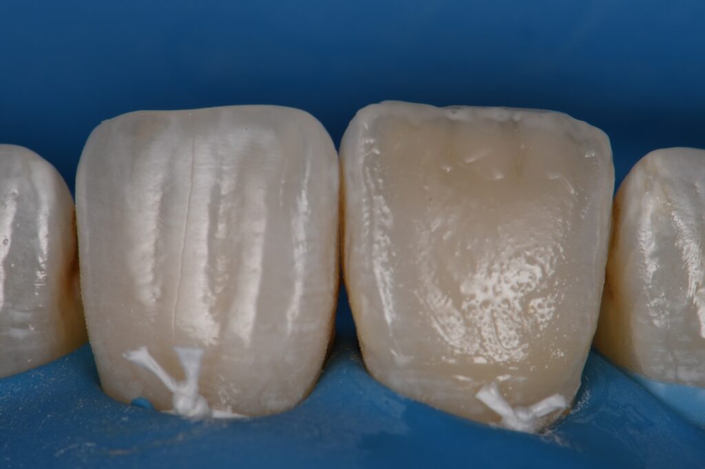 Composite Veneer | Voco Amaris