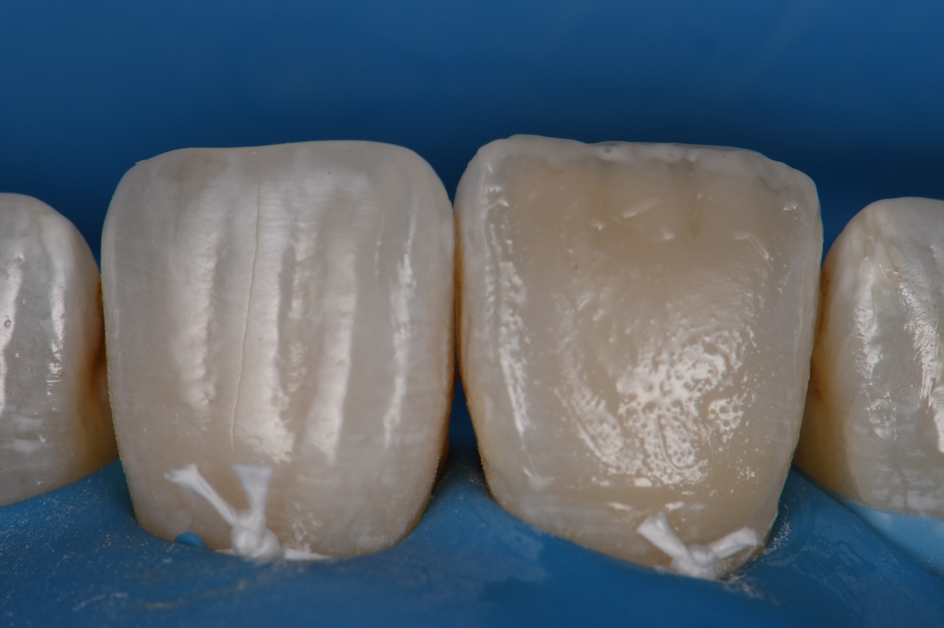 Composite Veneer | Voco Amaris