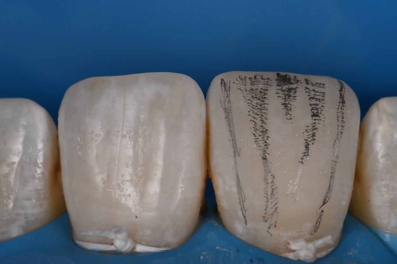 Composite Veneer | Voco Amaris