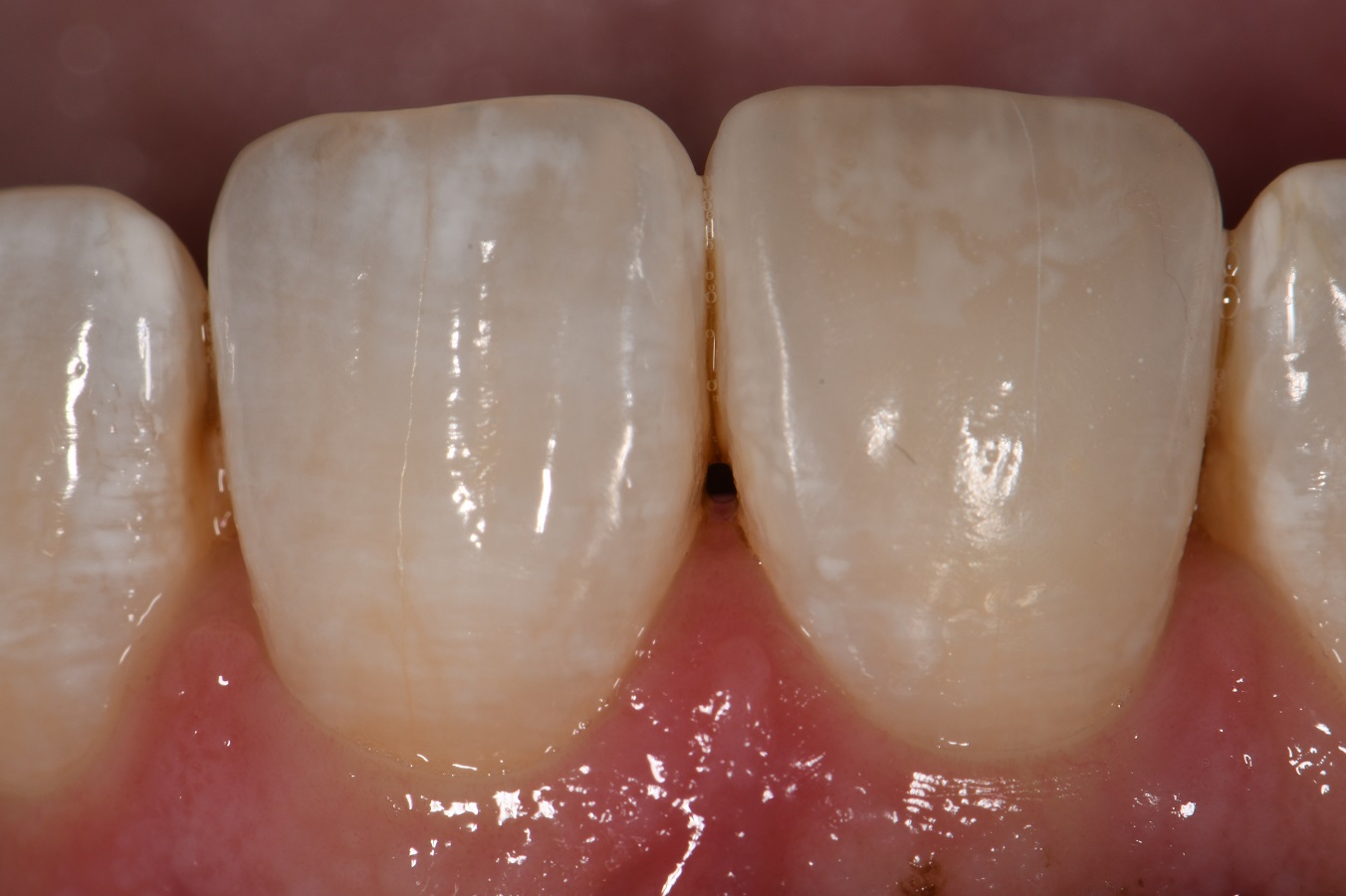 Composite Veneer | Voco Amaris