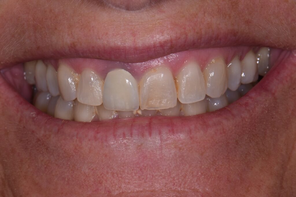 Smile Design with 5 porcelain veneers Smile Design with 5 porcelain veneers