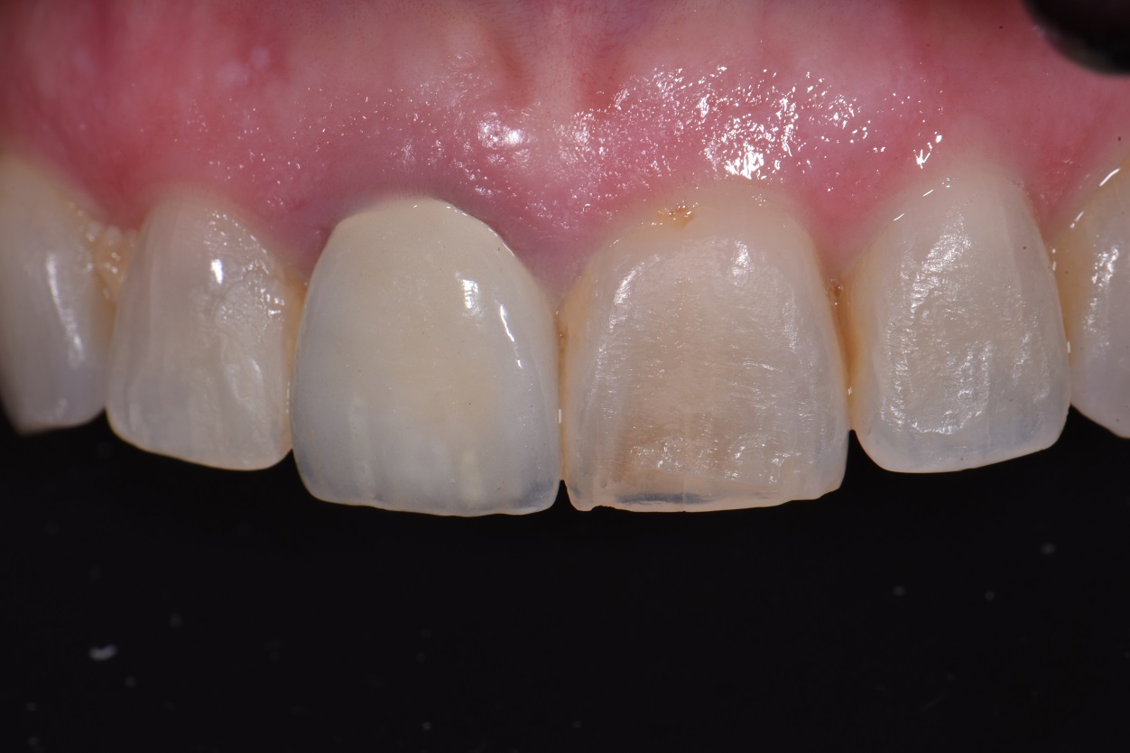 Smile Design with 5 porcelain veneers Smile Design with 5 porcelain veneers