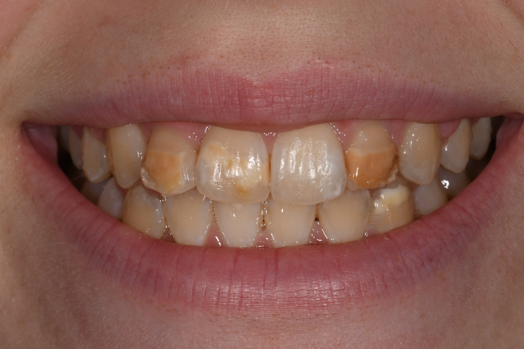 Esthetic Management of Incisor Hypomineralization