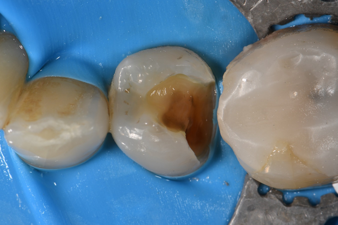 Class II Restorative Solution | Simplishade